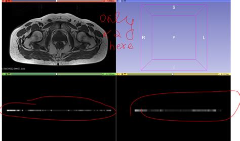 Bone Segmentation Through Mri Scan Dicom Images Support 3d Slicer