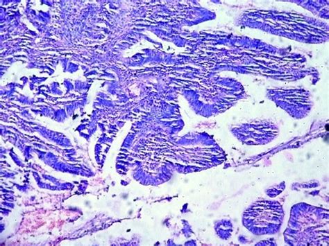 Teratocarcinoma In A Non Seminomatous Mixed Germ Cell Tumour Of The