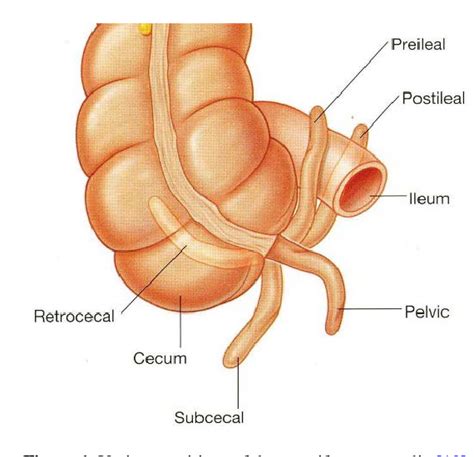 Figure 1 From Anatomical Positions Of Vermiform Appendix In Bangladeshi