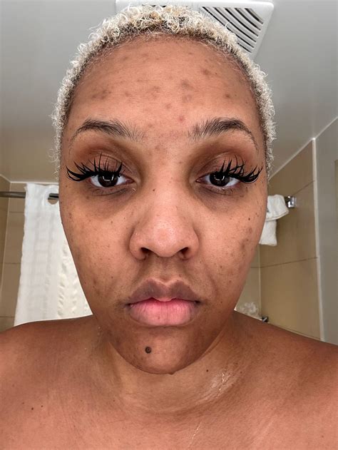 I Got Tretinoin Over The Counter For I Just Had To Fly To Abu Dhabi First Allure