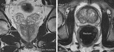 Benign Prostatic Hyperplasia Radiology Key