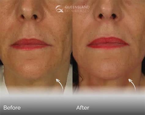 Before And After Hifu Treatment
