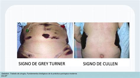 Signos De Grey Turner S