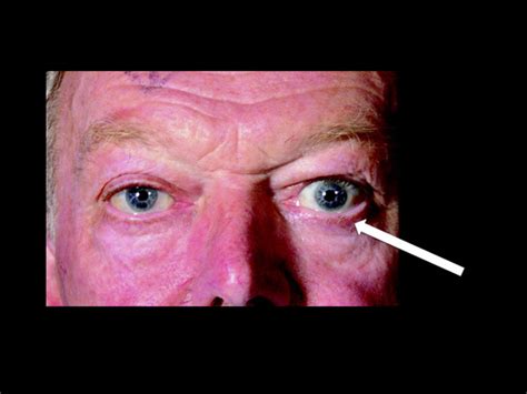 Thyroid Disease And The Eye Ocular Manifestations Of Systemic Disease