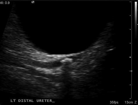 Ureteral Calculus