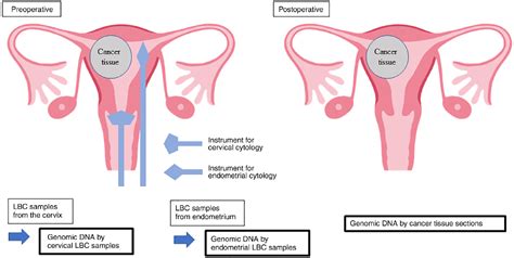 Figure From Cancer Associated Gene Analysis Of Cervical Cytology Samples And Liquid Based