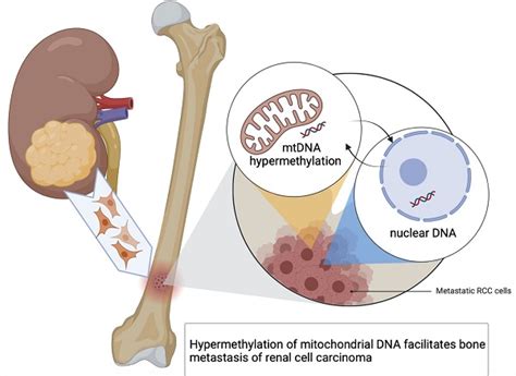 Hypermethylation Of Mitochondrial Dna Facilitates Bone Metastasis Of