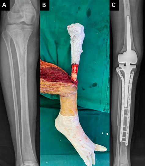 A Patient With Osteosarcoma In The Upper Right Tibia Underwent
