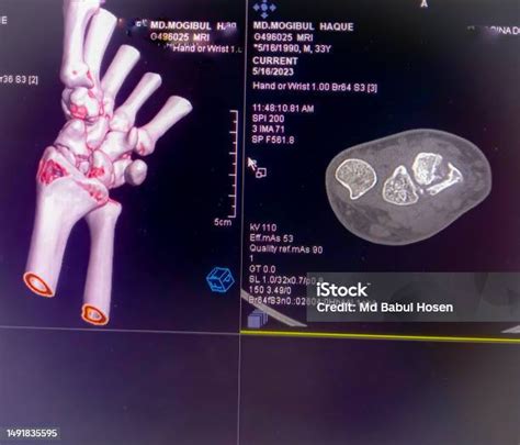 Ct Scan Image Of Wrist Joint Radiograph Show Wrist Bone Broken Medical Imaging And Technology