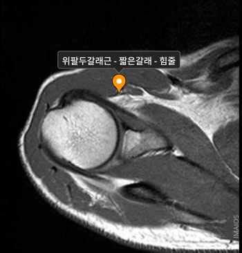 위팔두갈래근 짧은갈래 힘줄 E Anatomy Imaios