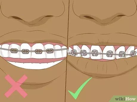 How To Make Fake Braces Retainers A Tutorial Artofit
