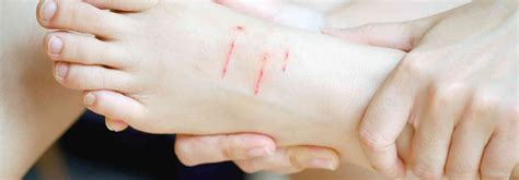 How Long Does A Tetanus Jab Last Midnight Pharmacy