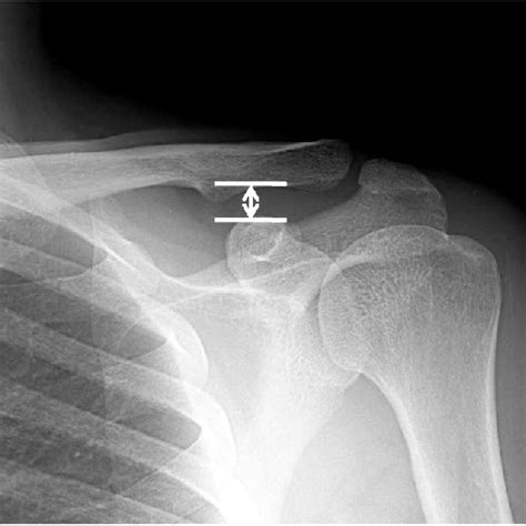 A Preoperative Stress Radiograph Shows Type V Acromioclavicular Download Scientific Diagram
