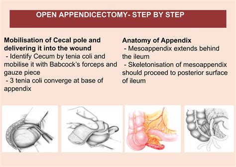 Acute Appendicitis Appendicectomy Open And Laparoscopicpdf