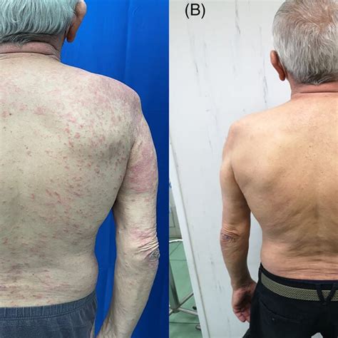 Back Of The Patient A After 8 Months Of Brodalumab Therapy B After