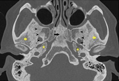 Imaging Of Middle Cranial Fossa And Fifth Cranial Nerve Trigeminal