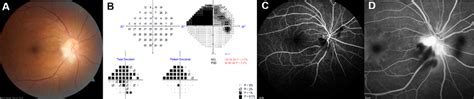 Figure 3 From Altitudinal Visual Field Defects Following Diagnostic Transfemoral Cerebral