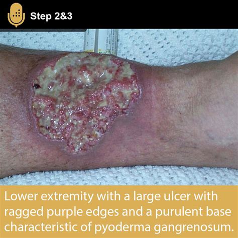 Pyoderma Gangrenosum Ibd