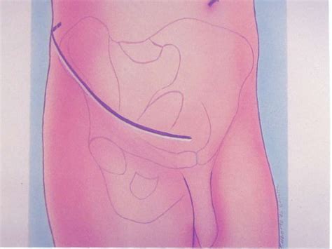 Acetabular Fractures Ppt