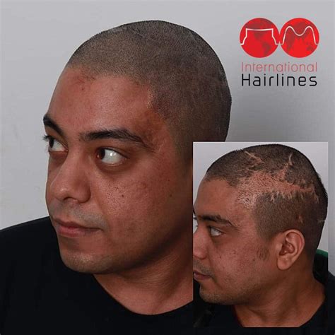 Scalp Micropigmentation Aftercare International Hairlines