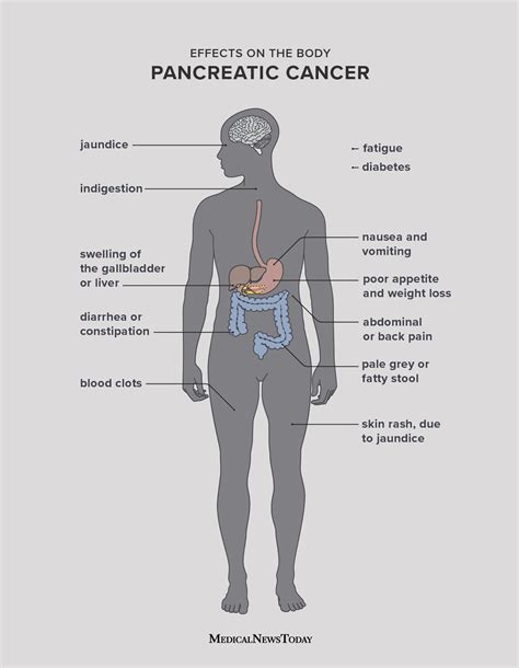 Pancreatic Cancer Symptoms In Men