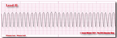 The Ecg Educator And Mentor Blog Ventricular Flutter