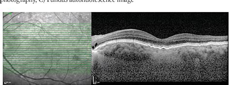 Figure 2 From Optical Coherence Tomography Characteristics Of Quiescent