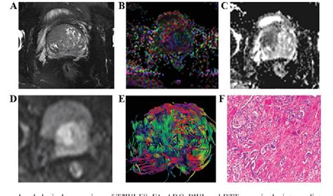 Figure 2 From Correlation Of Diffusion Tensor Imaging Parameters And