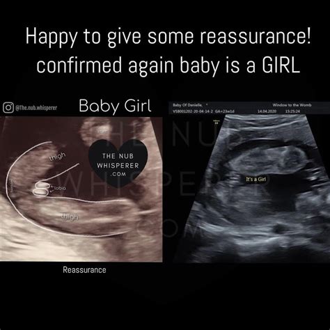 Gender Scan Reassurance Sometimes You Just Dont Believe It However There Has Been Many W