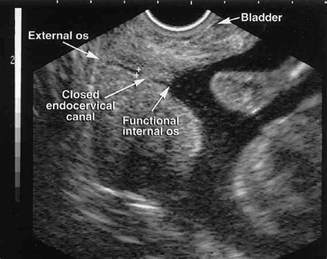 Internal Cervical Os Model Canal
