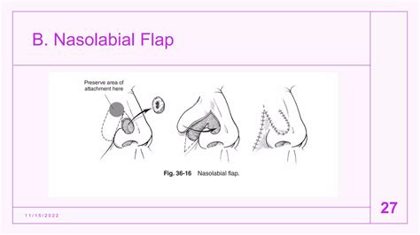Nasal Reconstruction Pptx Ear Nose And Throat Conditions Diseases And Conditions