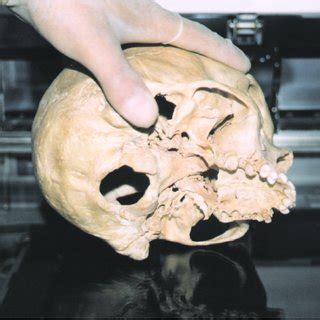 PDF Sexing The Human Skull Through The Mastoid Process