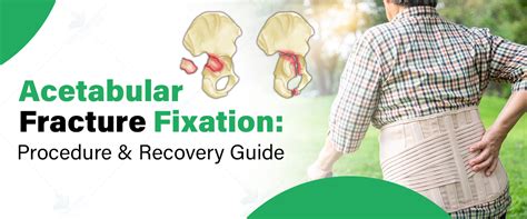 Acetabular Fracture Fixation Procedure And Recovery Guide