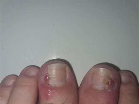 Hypergranulation Tissue Post Surgery R Ingrown Toenails