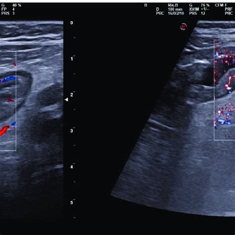 Cross Sectional And Longitudinal Us Image Of Intestinal Loop Wall Download Scientific Diagram