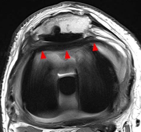 Arthrofibrosis Of The Knee Radsource