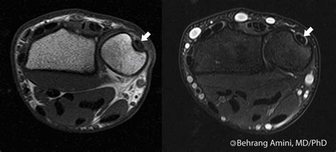 Roentgen Ray Reader Extensor Carpi Ulnaris Tendon Normal Signal Intensity