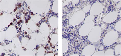 Pathology Outlines Kappa And Lambda Light Chains Pathology Outlines Kappa And Lambda Light Chains