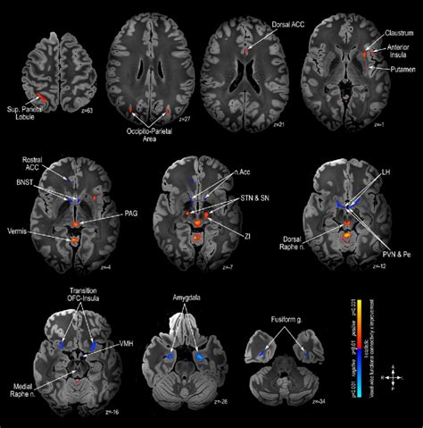 Functional Connectivity Mapping Magnetic Resonance Imaging Mri In