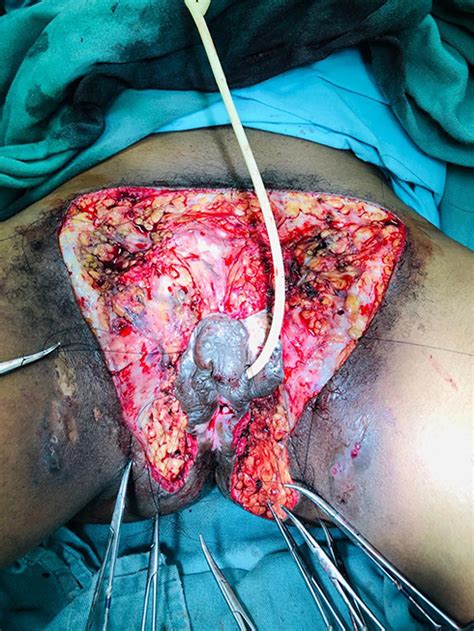 Hidradenitis Suppurativa As A Paradoxical Side Effect To The Use Of Ad