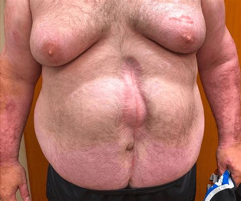 Treating Heterotopic Ossification Ho The Formation Of Ectopic Bone In Soft Tissue A