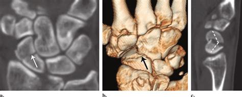 Scaphoid Waist Fracture A B Coronal Reformatted A And 3d B Ct