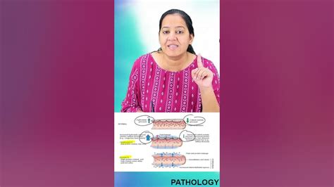 Transudate Versus Exudate Youtube