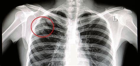 Comprehensive Tb Testing For Healthcare Workers In Nyc