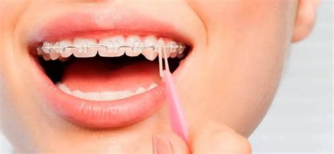 Elásticos Intermaxilares La Clave Para Una Mordida Perfecta Ortodoncia Junin