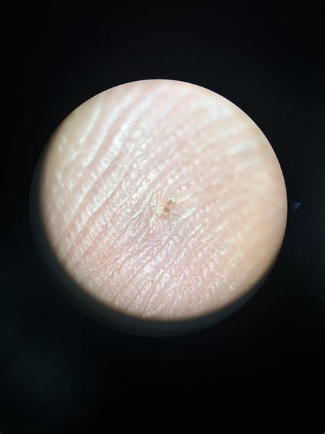 Tiny Glass Shard In My Thumb Rpopping