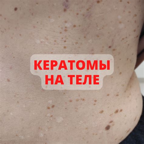 Кератомы на теле (фото заболевания в конце) | Советы дерматолога ...