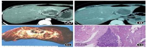 Hepatic Resection For Intrahepatic Cholangiocarcinoma After Chinese Medical Journal