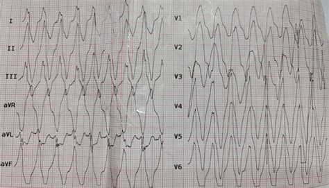 Ventricular Tachycardia Caused By Hyperkalemia Download Scientific