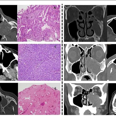 Non Tumoral Pathology Affecting Maxillary Sinus Showing The Main